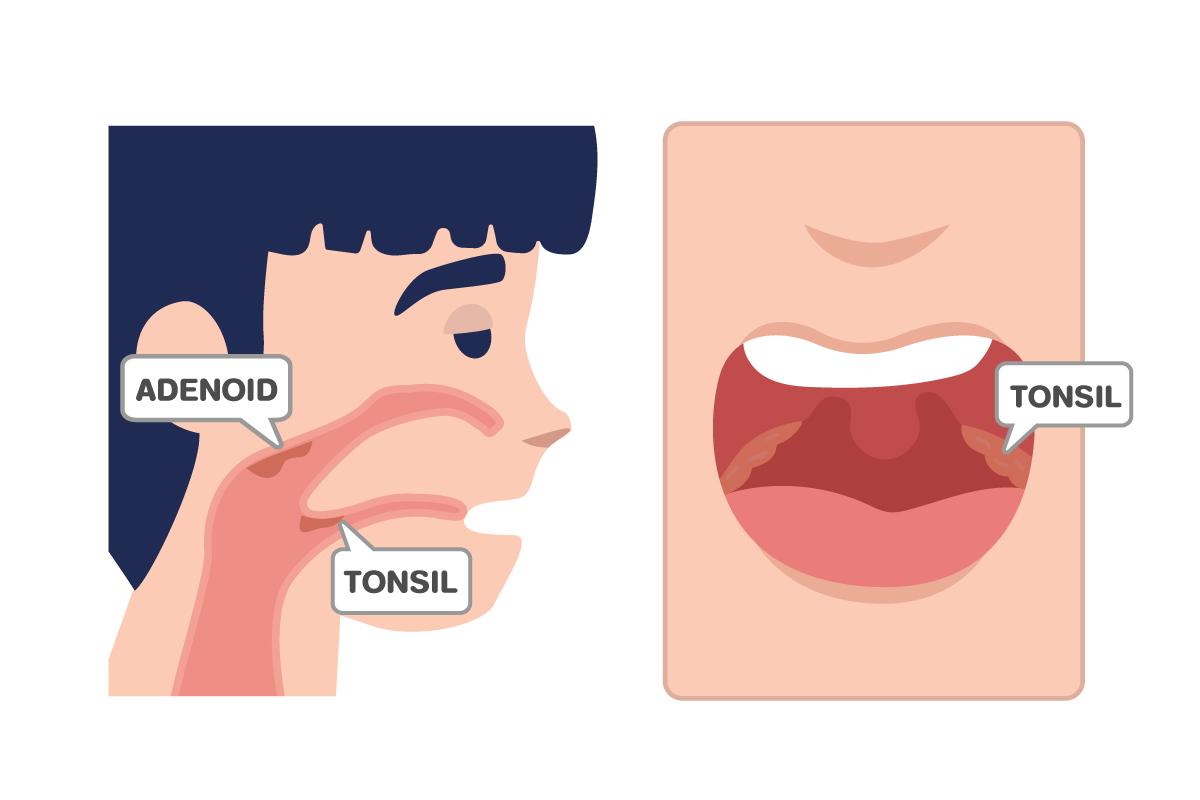 เด็กนอนกรน เสียงหายใจเหมือนเป่าปี่ สังเกตให้ดี..สัญญาณเตือนโรคนี้!!!